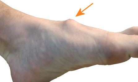 Een bult op je wreef die pijn doet in je skischoen?